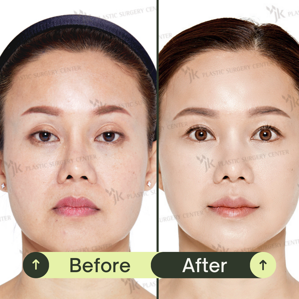 Fat Grafting For Face in South Korea Better Value Than Australia and ...